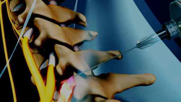 Medial Branch Nerve Block Vs. Facet Injection: What's The Difference?